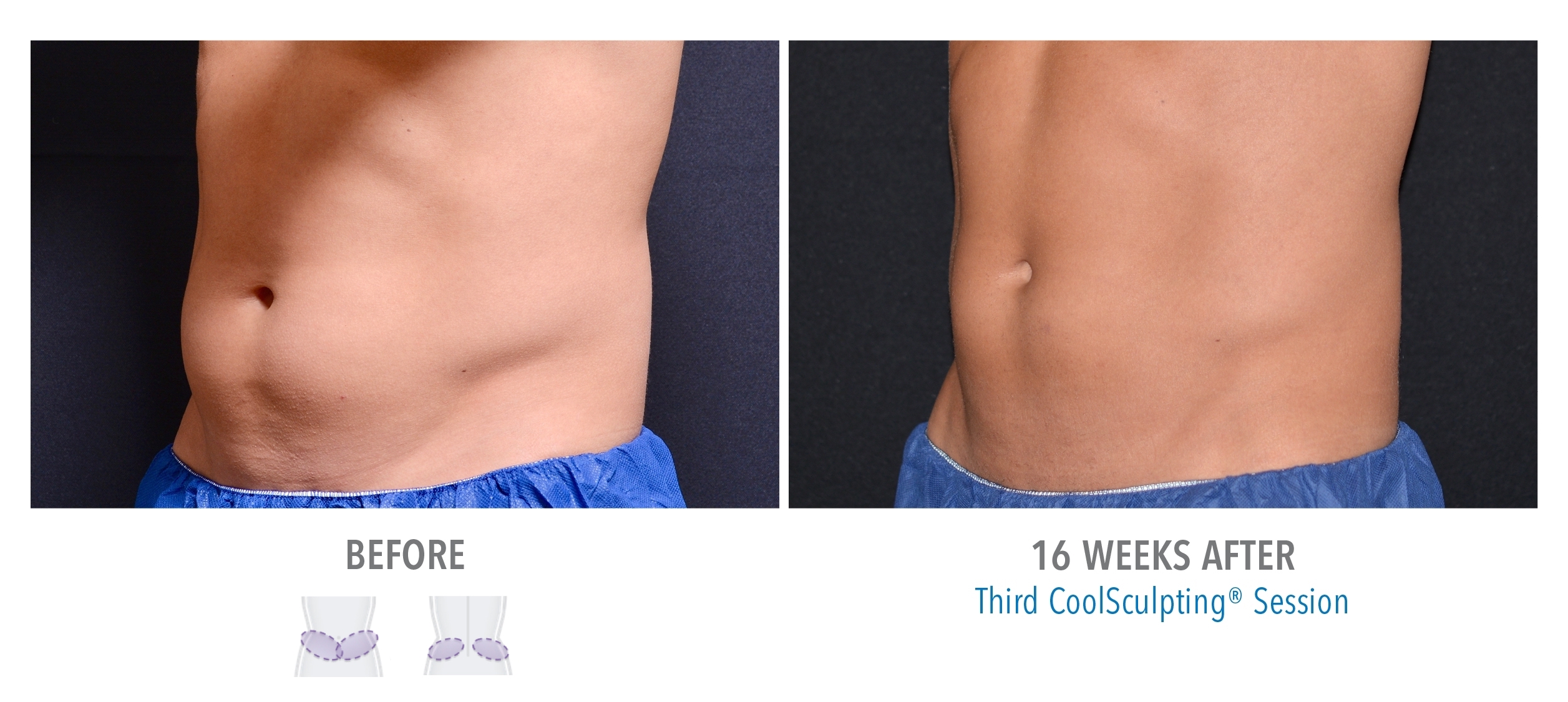 Bodenvy Orlando | Get Your CoolSculpting Pricing