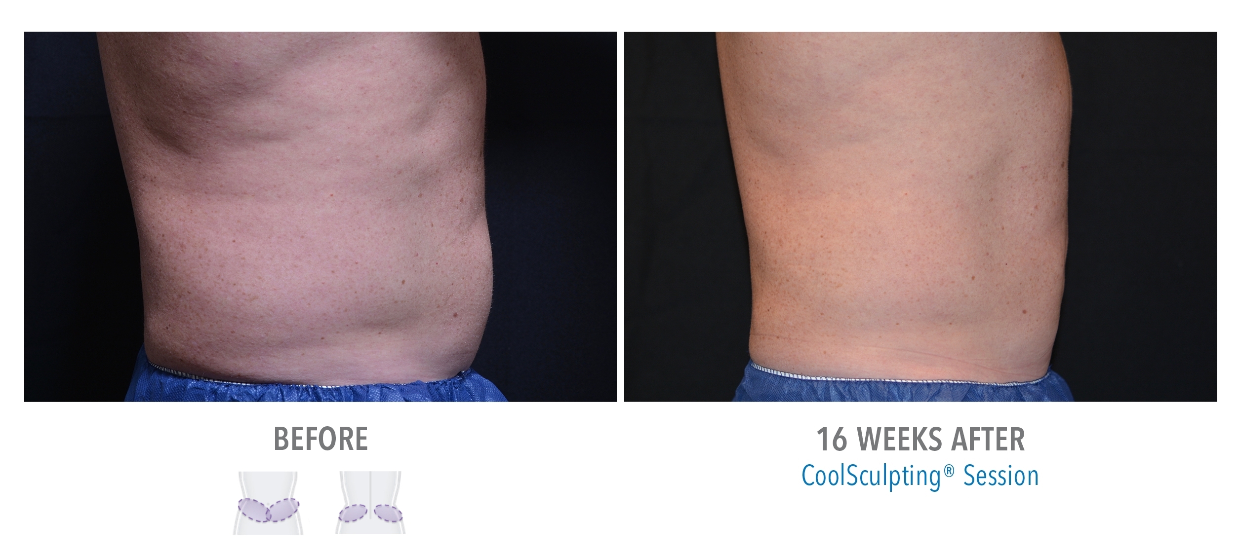 Bodenvy Orlando | Get Your CoolSculpting Pricing