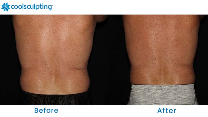 CoolSculpting Before and After Pictures